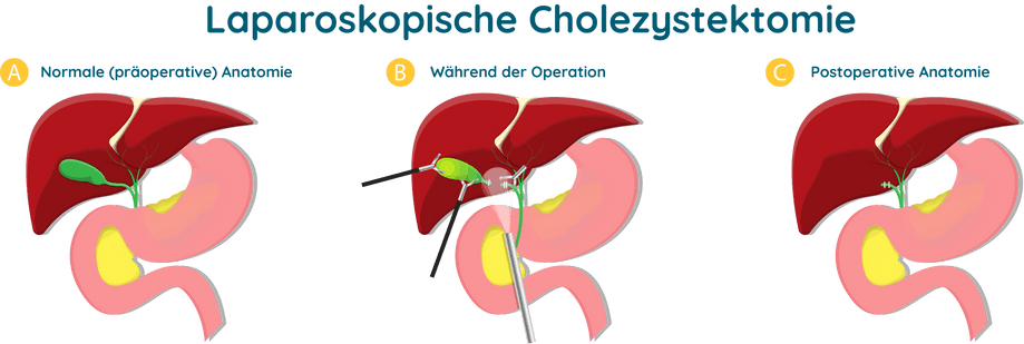 Gallensteine | Dr. Sonja Nakhai in Maria Enzersdorf